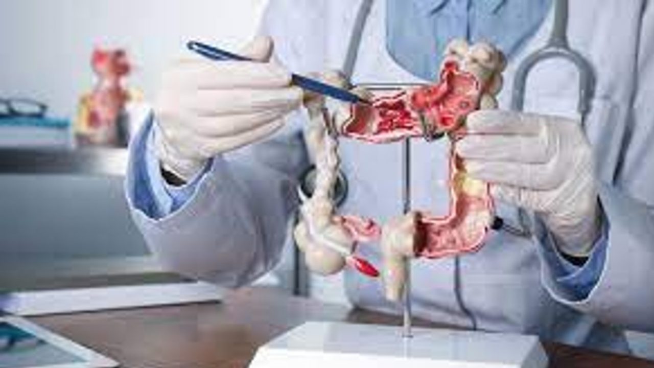 ¿Qué es el cáncer de colon? Causas, síntomas y tratamiento